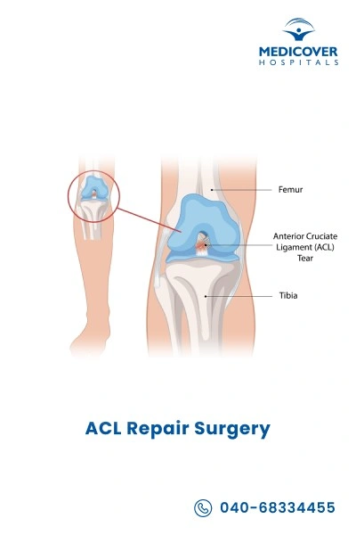 ACL Reconstruction Surgery: Steps, Risks and Recovery