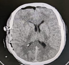 Extra Dural Hematoma: A Success Story