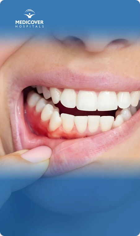 Bleeding Gums and Bad Breath: Causes, Symptoms, and Preventions